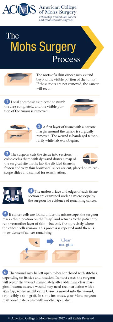 Mohs Surgery - Dermatologic Surgery of the Carolinas